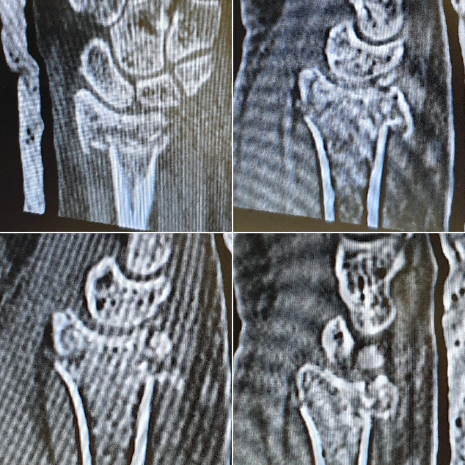 Fractura de epifiza distala - Ce este si cum o tratam? - Alqadi Ahmad