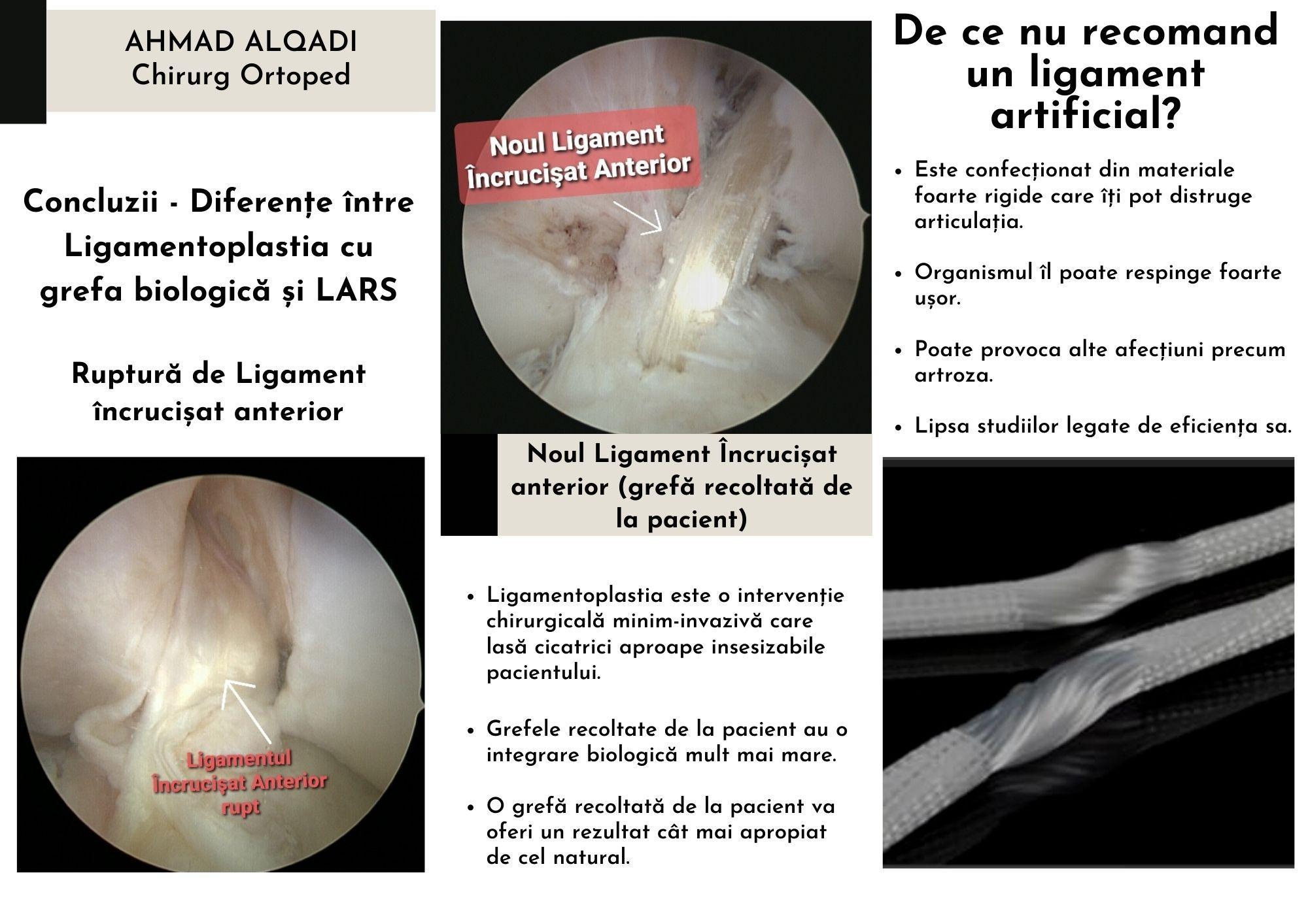 Ligamentoplastia cu tehnica LARS iti poate distruge articulatia. Ce ...