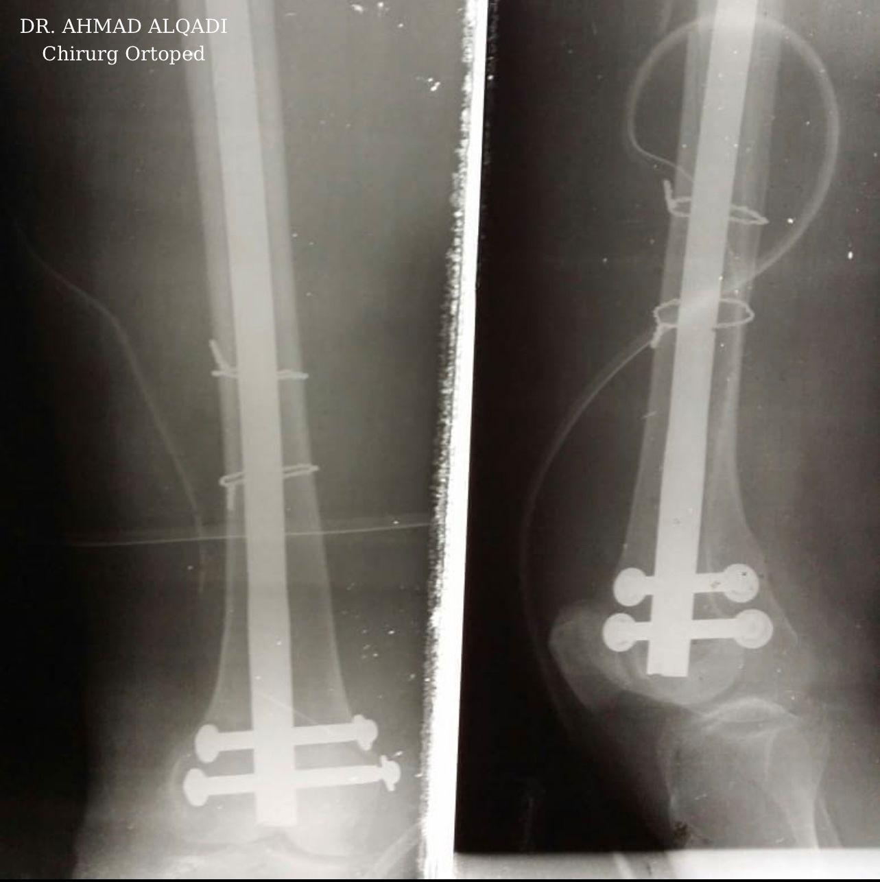 Fractura de femur - Cauze frecvente si tipuri de tratament - Alqadi Ahmad