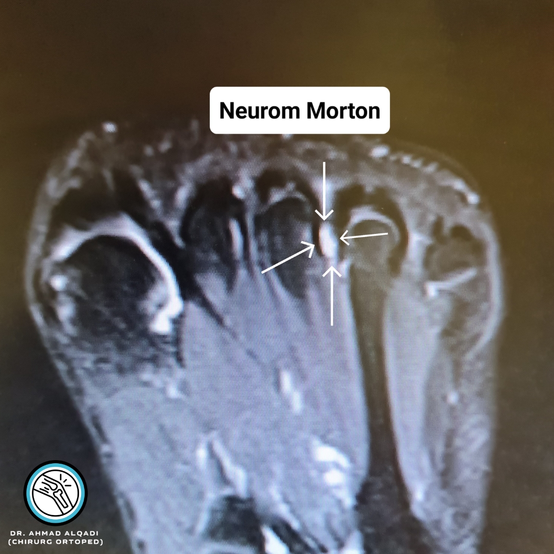 Neuromul Morton Ce este si cine este mai predispus sa il dezvolte?