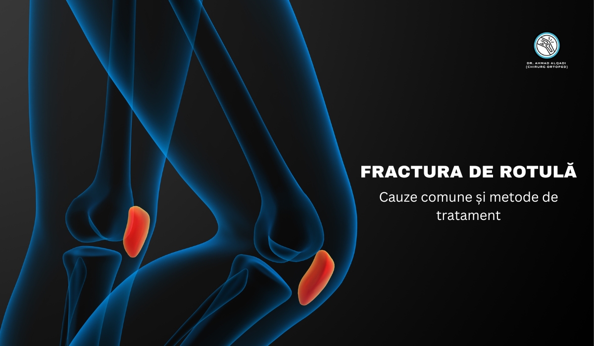 Fractura de rotulă – Cauze comune și metode de tratament